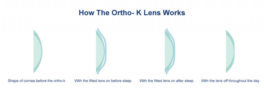 Are Ortho K Contacts For You? - Contacts Advice